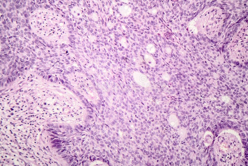 Basal cell carcinoma stock photo. Image of microphotograph - 128777674