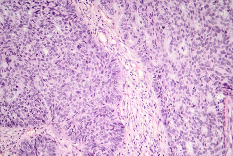 Basal cell carcinoma stock image. Image of stain, medical - 128777713