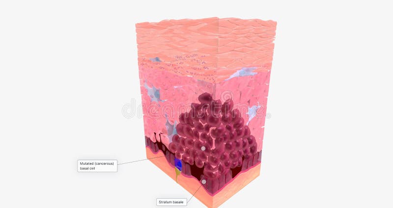 Basal Cell Carcinoma in Tissue, Stage 0 Stock Illustration ...