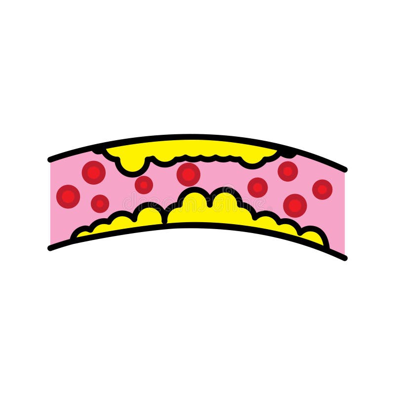 Cholesterol Icon, Artery Blocked with Cholesterol, Line Illustration ...