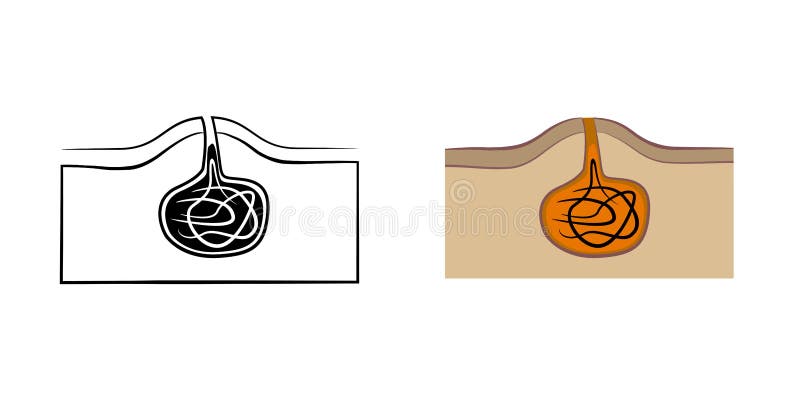 Pilonidal Cyst Icon , Line Color Vector Illustration Stock Vector ...