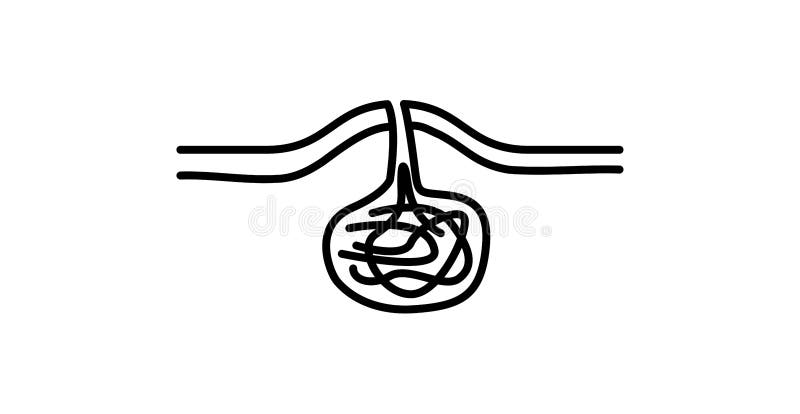 Pilonidal Disease. Skin Infection or Cyst with Ingrown Hair between ...