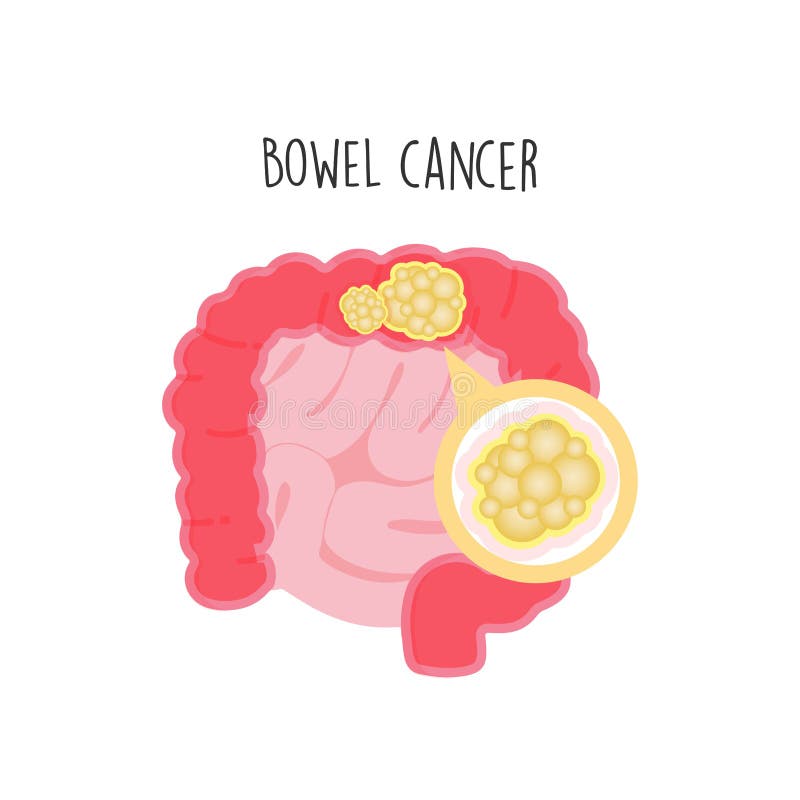 Bowel Cancer Flat Illustration. Stock Illustration - Illustration of ...