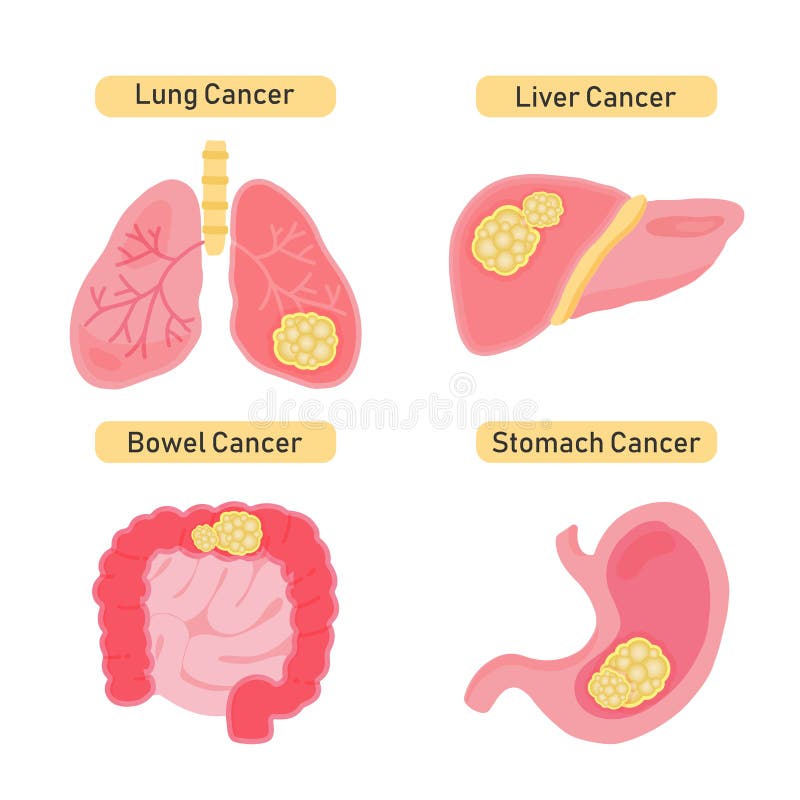 Cancer Types Flat Illustration. Stock Illustration - Illustration of ...