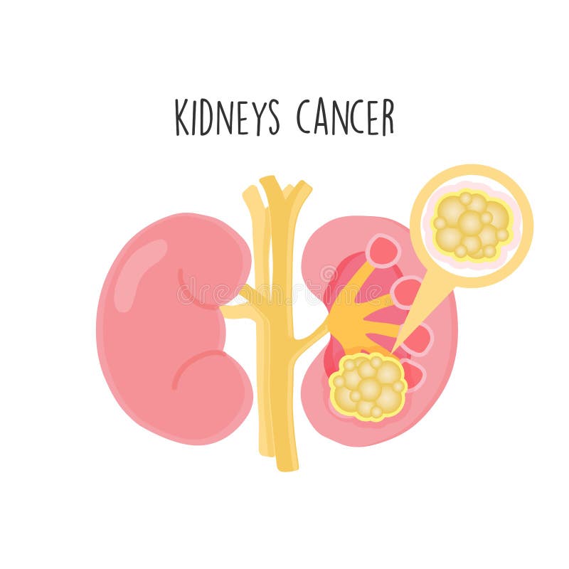 Kidney Cancer Flat Illustration. Stock Illustration - Illustration of ...