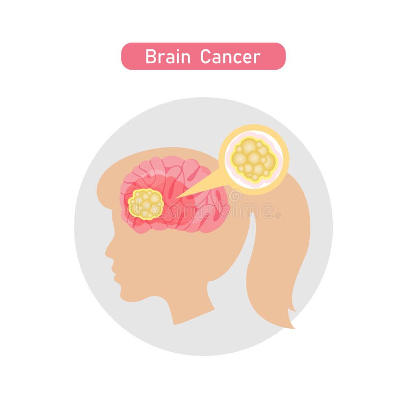 Brain Cancer Symptoms Stock Illustrations – 133 Brain Cancer Symptoms ...