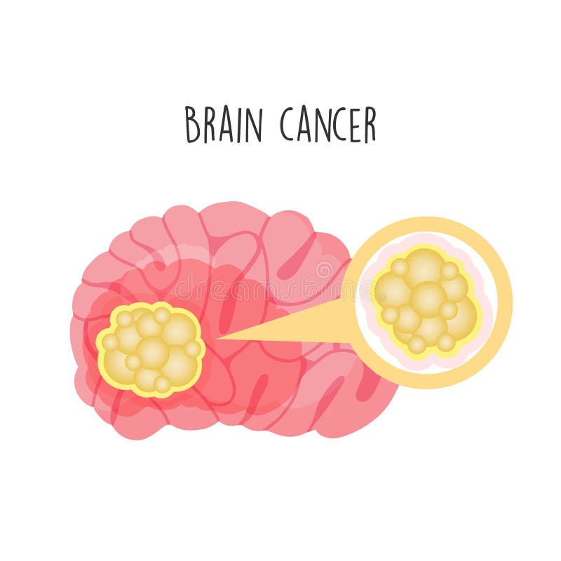 Brain Cancer Tumor Symptoms Stock Illustrations – 66 Brain Cancer Tumor ...