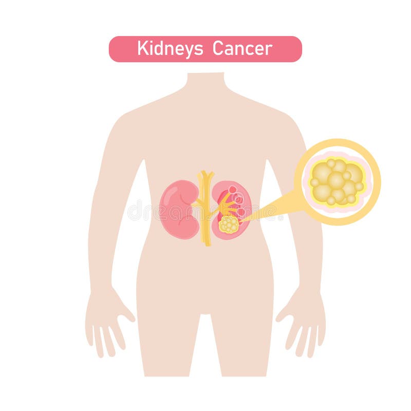 Kidney Cancer Diagram .Vector Illustration in Flat Style. Stock ...