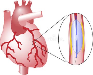 Shunt Medical Stock Illustrations – 55 Shunt Medical Stock ...