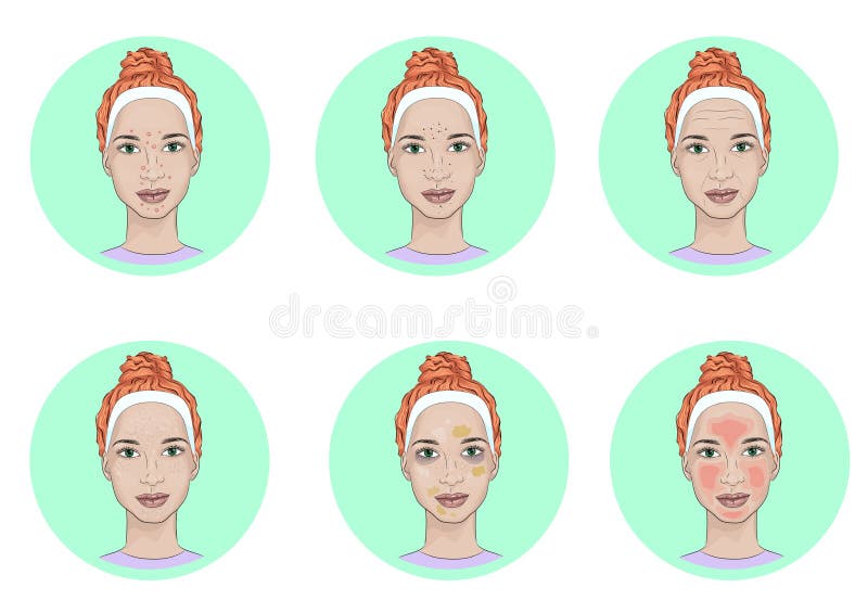 Illustration of the Common Face Skin Problems Stock Vector ...