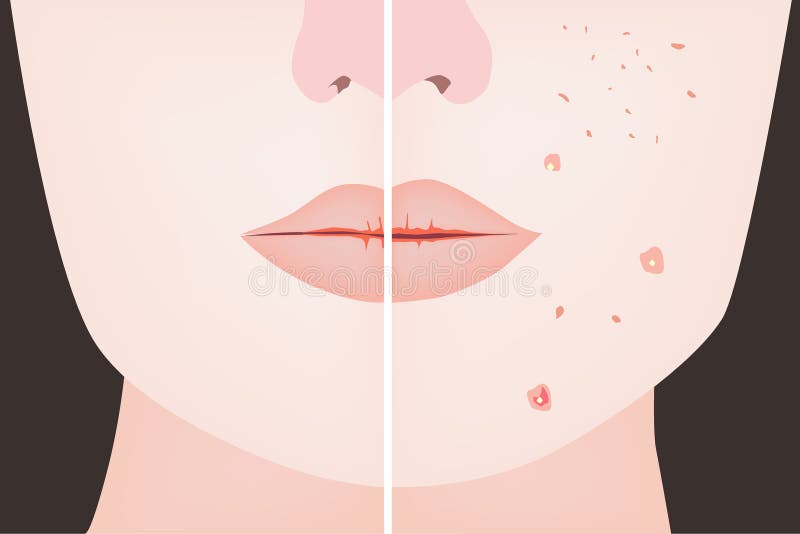 Comparision of Pure Face and Acne Face Stock Illustration ...