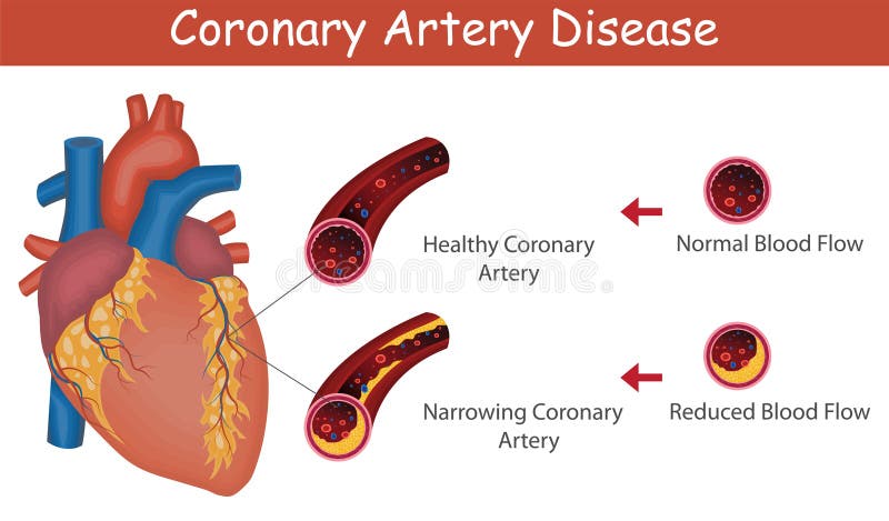 Coronary Artery Disease Diagram with Heart Arteries. Stock Vector ...