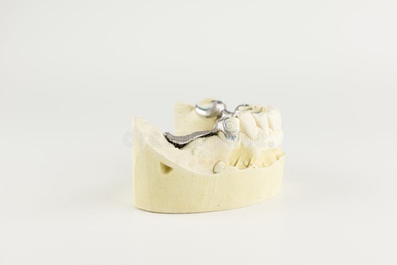 Basis of the Clasp Prosthesis on the Gypsum Model Stock Image - Image ...