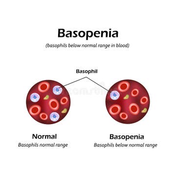Basopenia Stock Illustrations – 1 Basopenia Stock Illustrations ...