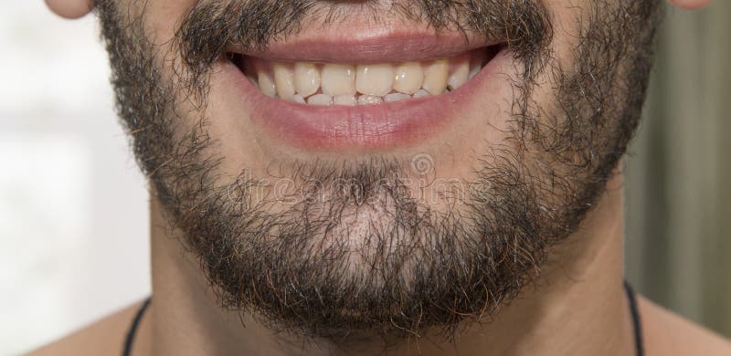 The Bearded Man Smiles, Showing Bad Teeth. Stock Photo - Image of body ...
