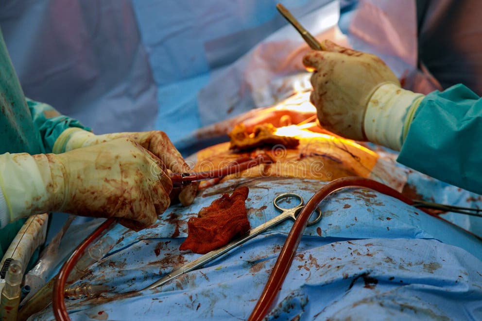 Beating Human Heart in Opened Chest during the Surgery Chest Stock ...