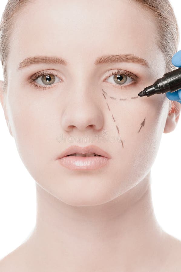 Correction Lines on Woman Face, before Surgery Stock Photo - Image of ...