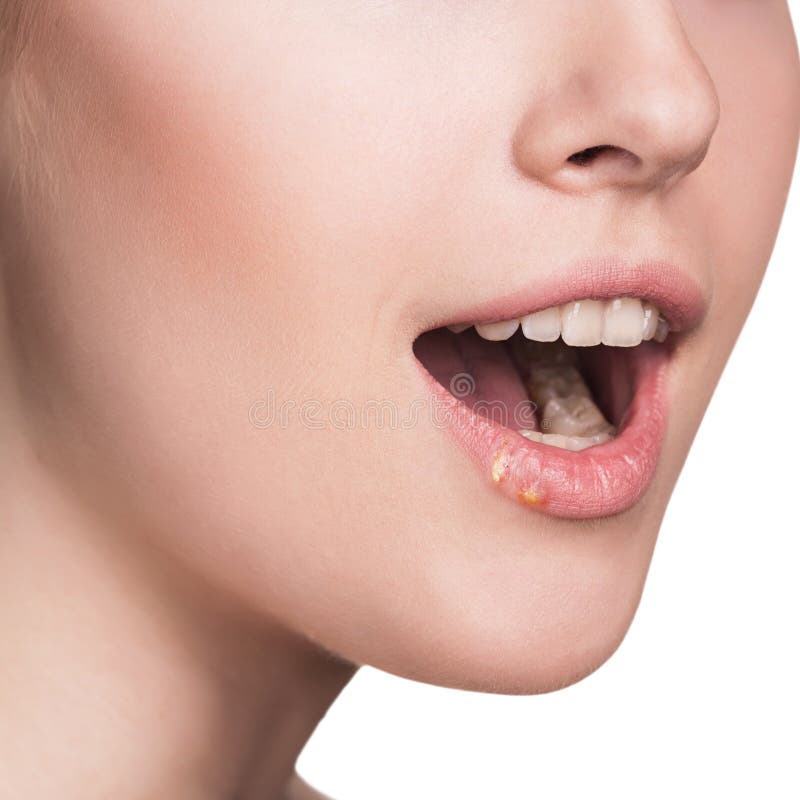 Beautiful Lips Infected Herpes Virus Stock Image - Image of disgusting ...