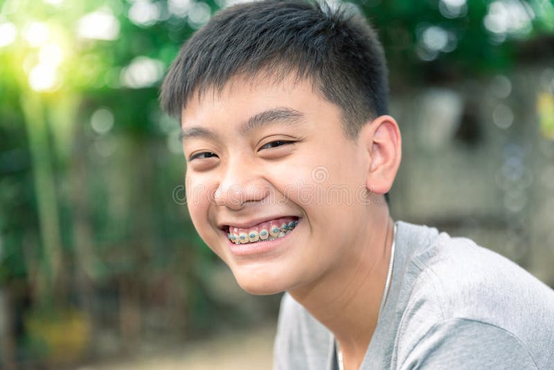 Beautiful Smiling of Handsome Boy with Teeth Brace Dental. Stock Photo ...