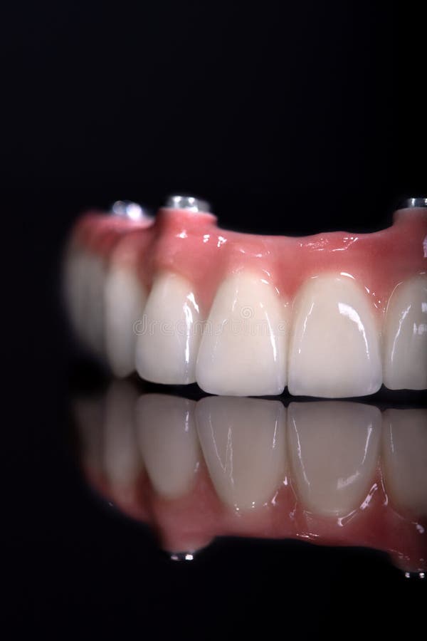 Beautiful Upper Teeth Ceramic Press Ceramic Crowns and Veneers on the ...