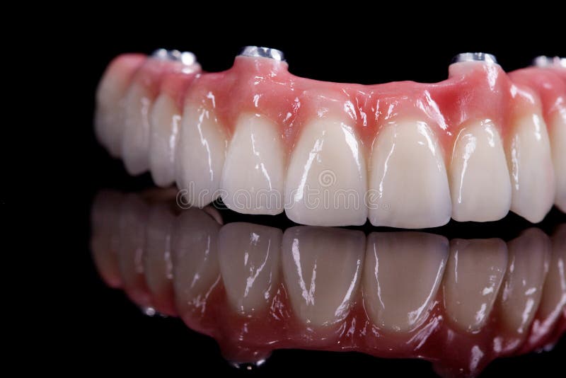 Beautiful Upper Teeth Ceramic Press Ceramic Crowns and Veneers on the ...
