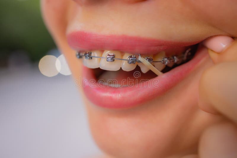 Beautiful Young Woman with Brackets on Teeth Close Up. Stock Image ...