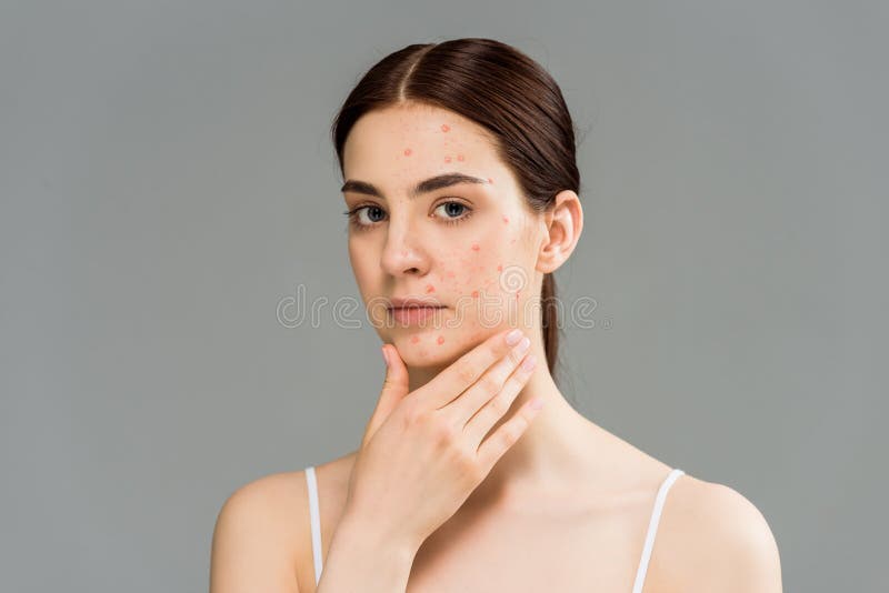 Young Woman with Pimples Touching Face on Grey Stock Photo - Image of ...