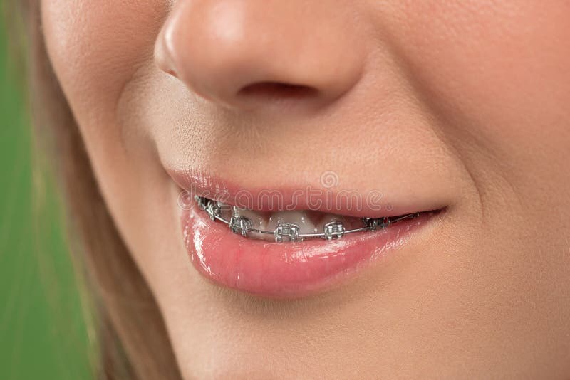 Beautiful Young Woman with Teeth Braces Stock Photo - Image of bone ...
