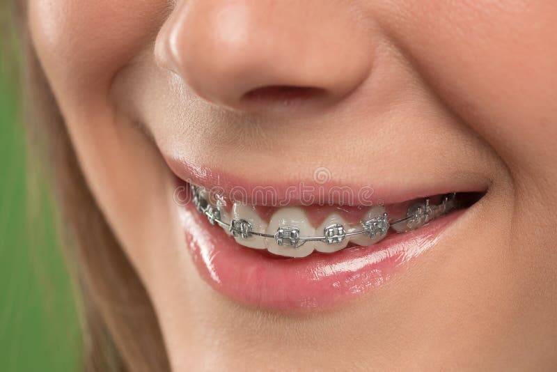 Beautiful Young Woman with Teeth Braces Stock Image - Image of medicine ...