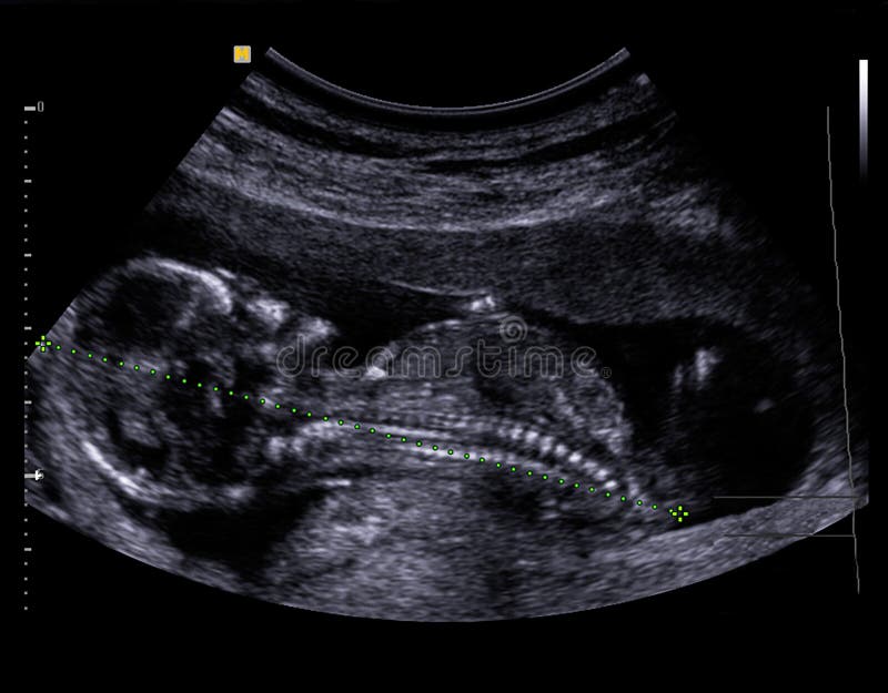 Radiografía De Un Torax Humano Foto de archivo - Imagen de examinación ...
