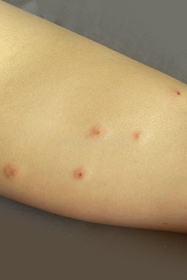 Bedbug Bites on Skin. Human Leg Close Up Stock Image - Image of allergy ...