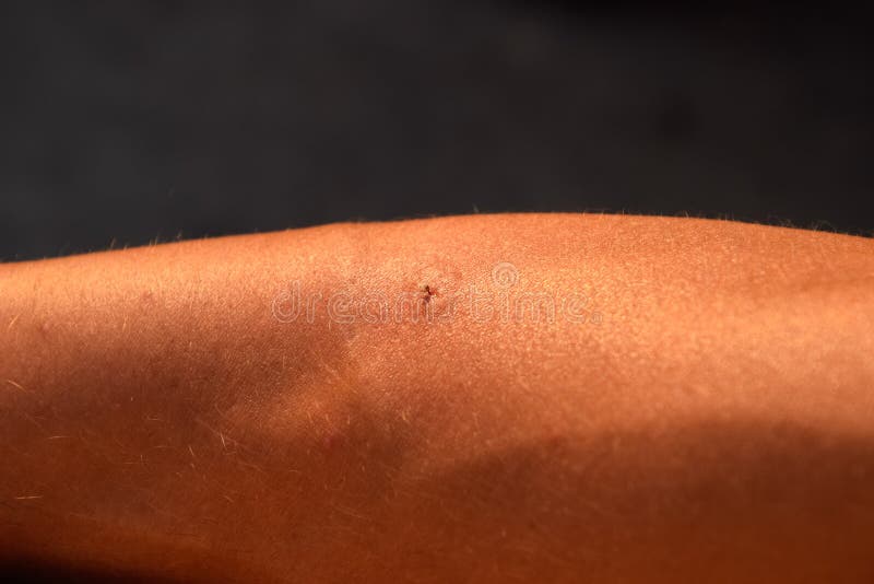 Bee Sting. Bee Sting in Human Skin. Consequences of Stinging with Bee ...