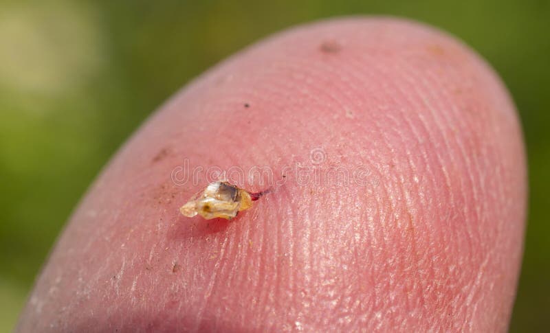 A Bee Stung a Mans Finger._ Stock Photo - Image of stung, alternative ...