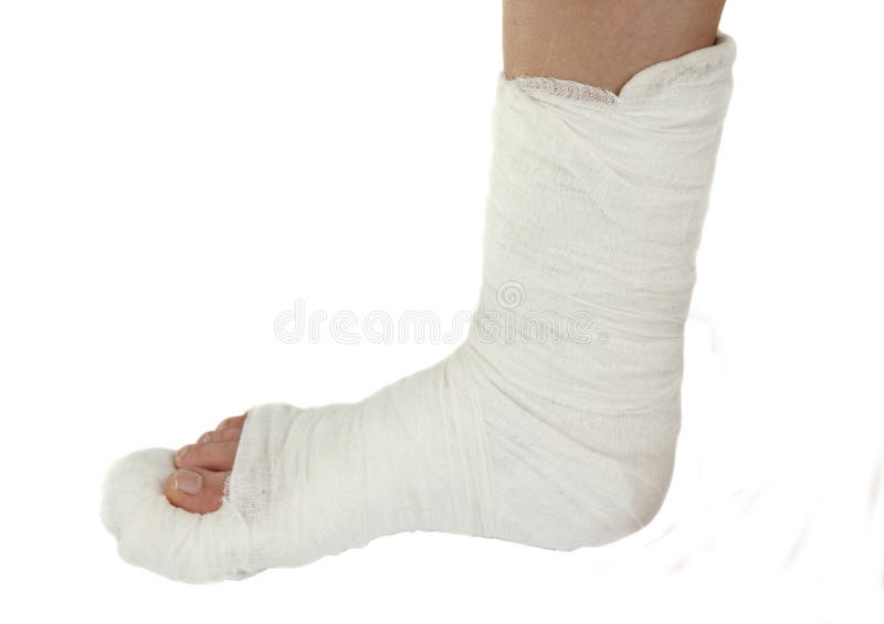 Been in het gips stock afbeelding. Image of deel, breuk - 25202747