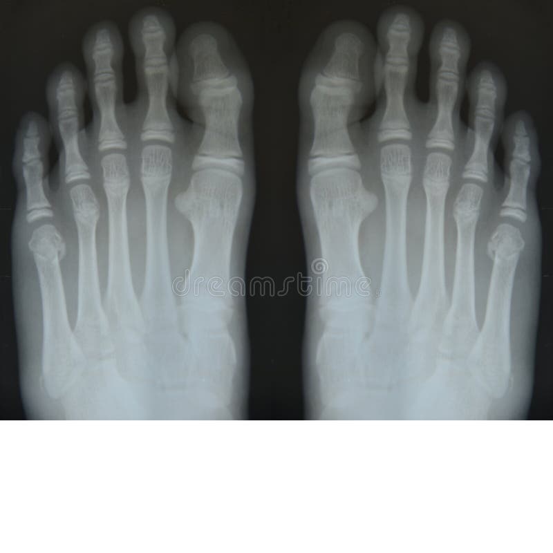 Been van voet x-ray film stock foto. Image of kliniek - 114335508