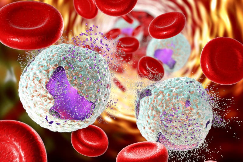 Behandeling Van Scherpe Lymphoblastic Leukemie Stock Illustratie ...