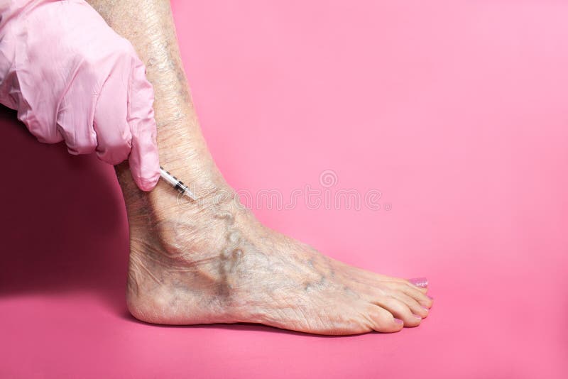 Behandeling Van Varikeus Vóór En Na Spataders Op De Benen Stock ...