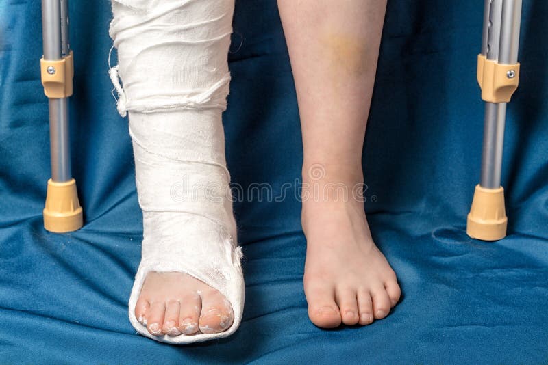 Vergipsen Sie Bein Nach Bruch Stockfoto - Bild von form, krücke: 142486576