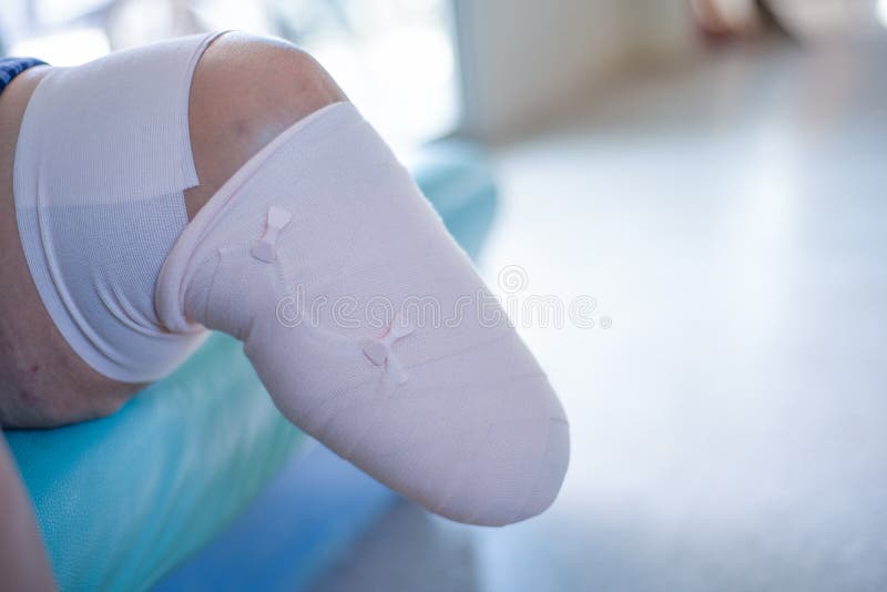 Below Knee Amputation Bandaging Stock Image - Image of elderly ...