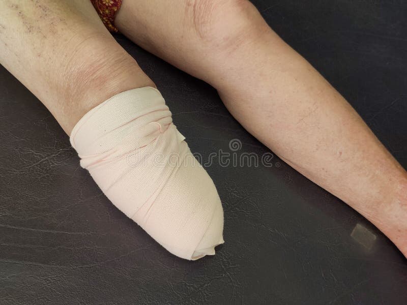 Below Knee Amputation Bandaging for BK Prosthesis Stock Image - Image ...