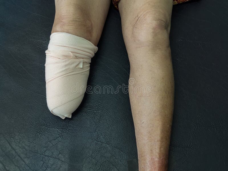 Prosthetic Below Knee Stock Photos - Free & Royalty-Free Stock Photos ...