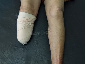Below Knee Amputation Bandaging for BK Prosthesis Stock Photo - Image ...
