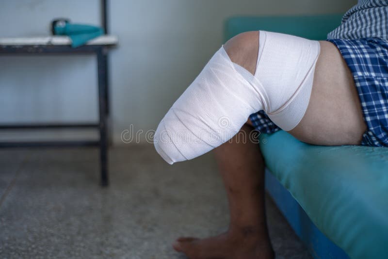 Below Knee Amputation Bandaging Stock Photo - Image of hospital ...