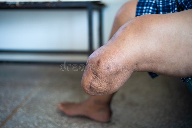 Below Knee Amputation Stump and Muscle Training Stock Image - Image of ...