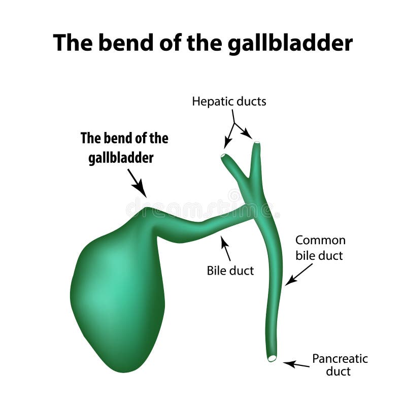 The Bend of the Gallbladder. Pathology of the Gallbladder Stock Vector ...