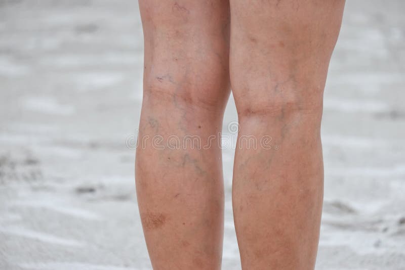 Benen Van Vrouwen, Littekens En Spataders Stock Afbeelding - Image of ...