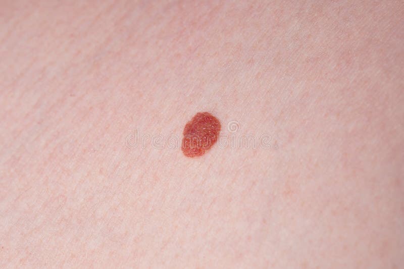 A Benign Mole on the Body. Medical Examination. Dermatologist Stock ...