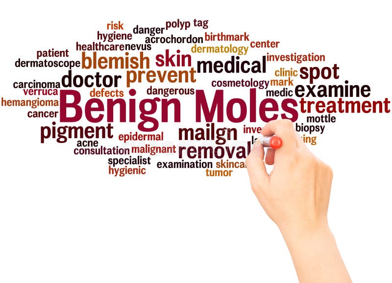 Benign Moles Word Cloud Hand Writing Concept Stock Image - Image of ... Benign Moles Word Cloud Hand Writing Concept Stock Image - Image of ...