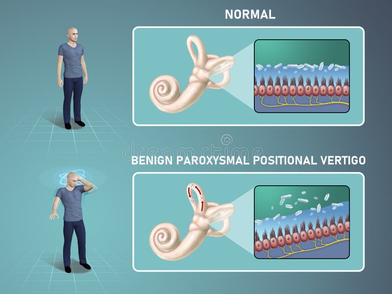 Benign Paroxysmal Positional Vertigo Stock Illustration - Illustration ...