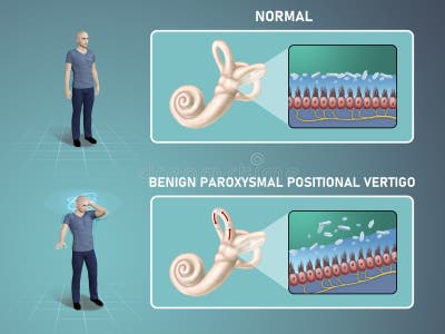 Benign Paroxysmal Positional Vertigo Stock Illustration - Illustration ...